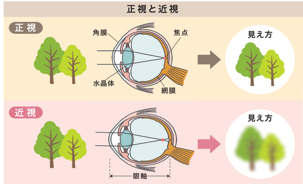 学年上がるほど「近視」が進行…児童生徒の近視実態調査 5枚目の写真・画像 | リセマム